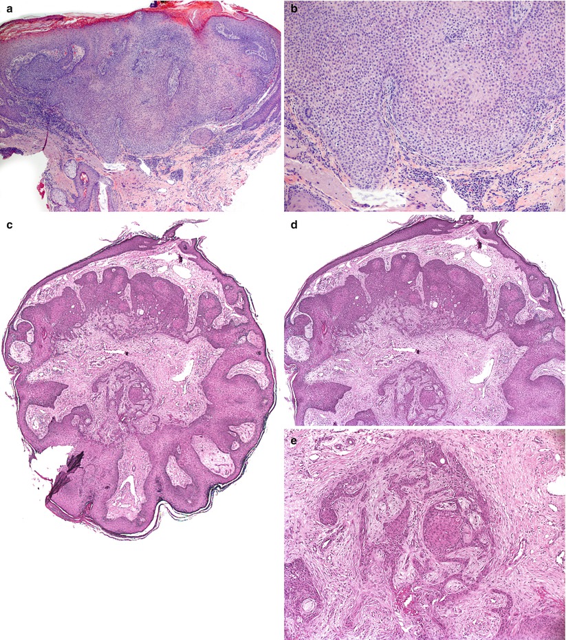Adnexal Neoplasms | SpringerLink