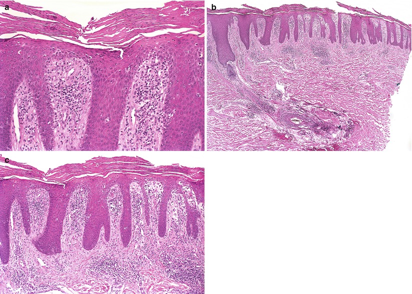 Psoriasiform Dermatoses | SpringerLink