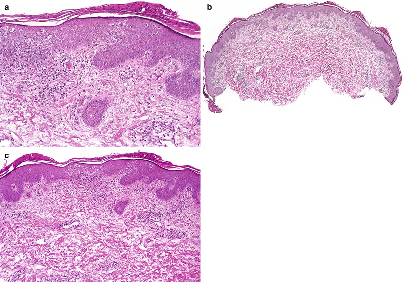 Psoriasiform Dermatoses | SpringerLink