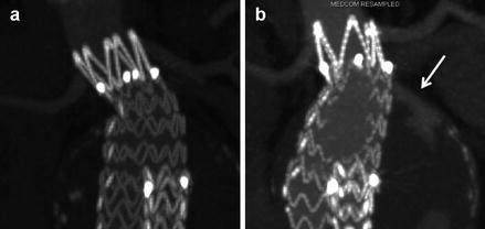 Type 1A Endoleak Following EVAR Treated with a Proximal Cuff | SpringerLink