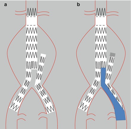 Maldeployment of the Contralateral Limb During EVAR | SpringerLink