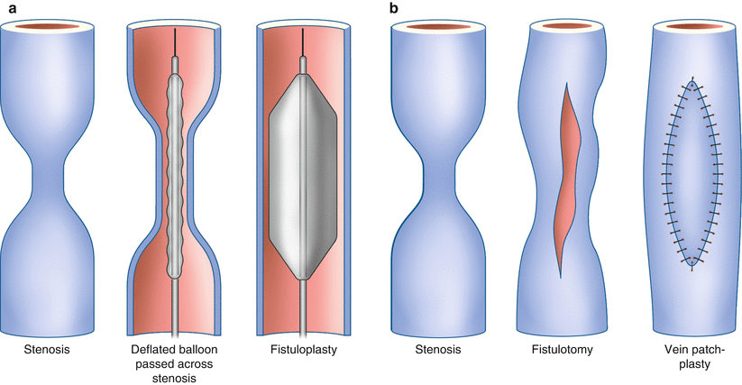 Vascular Access: Improving Outcomes for Haemodialysis Patients ...