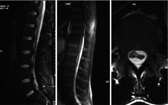 Lumbar Puncture and CSF Analysis and Interpretation | SpringerLink