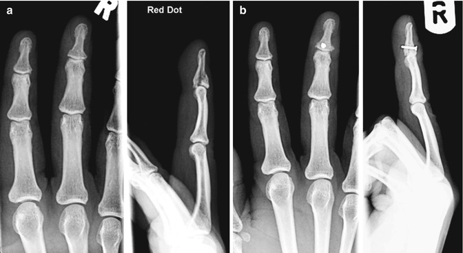 Distal Interphalangeal Joint and Fractures of the Distal Phalanx ...