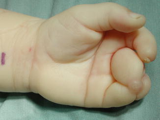 Constriction Ring Syndrome | SpringerLink