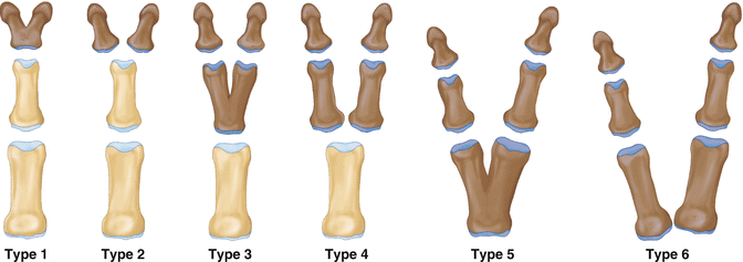Polydactyly | SpringerLink