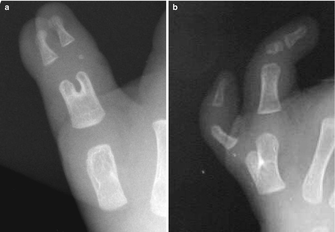 Polydactyly | SpringerLink