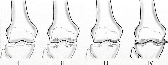 Osteonecrosis of Femoral Condyles | SpringerLink
