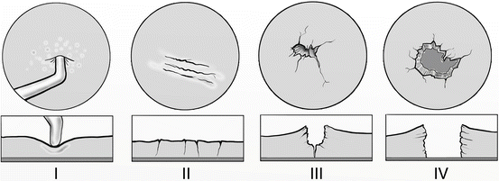 Chondral Lesions | SpringerLink