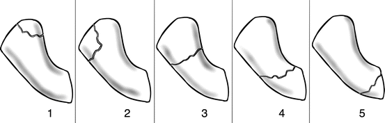 Scaphoid Fractures | SpringerLink