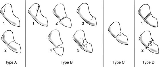 Scaphoid Fractures | SpringerLink