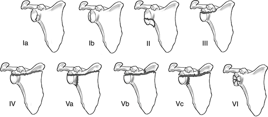 Glenoid Fractures | SpringerLink