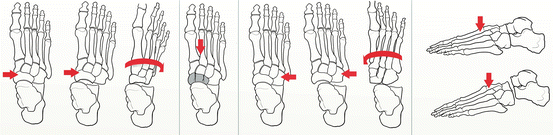 Midtarsal Bones: Chopart Joint Dislocations | SpringerLink