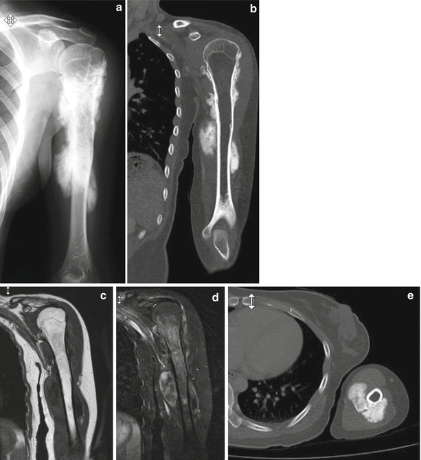 Parosteal Osteosarcoma | SpringerLink