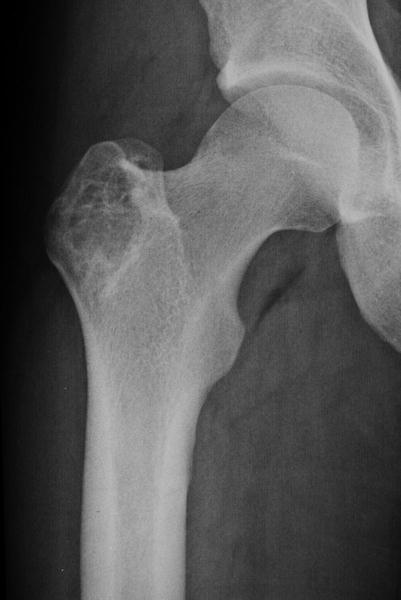 Chondroblastoma | SpringerLink