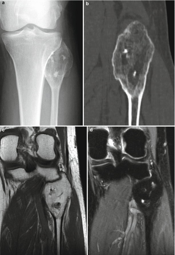 Lipoma of Bone | SpringerLink