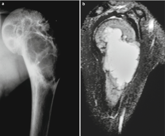 Simple Bone Cyst | SpringerLink