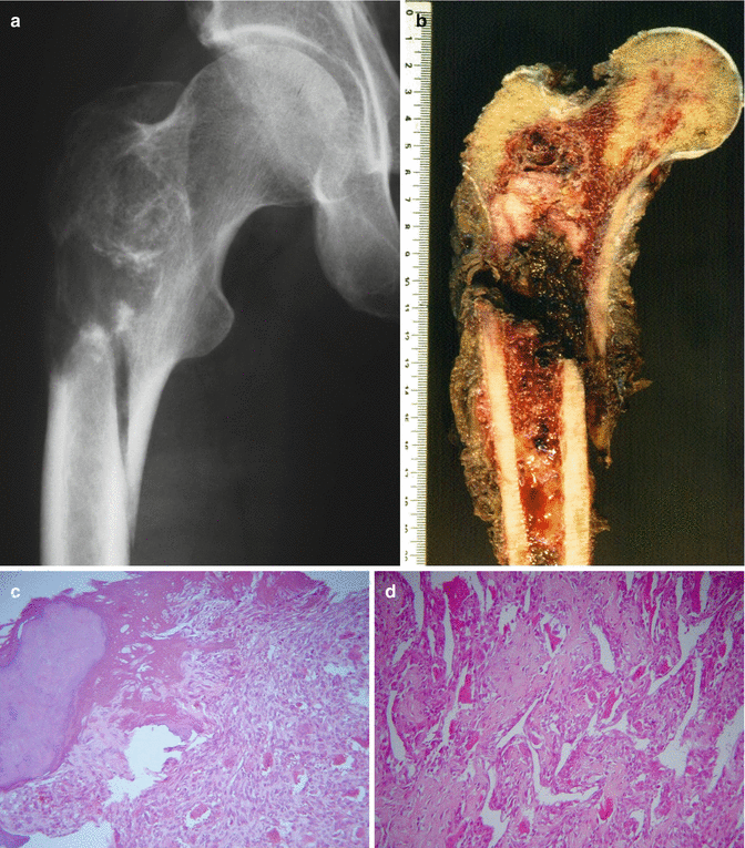 Bone Infarct | SpringerLink