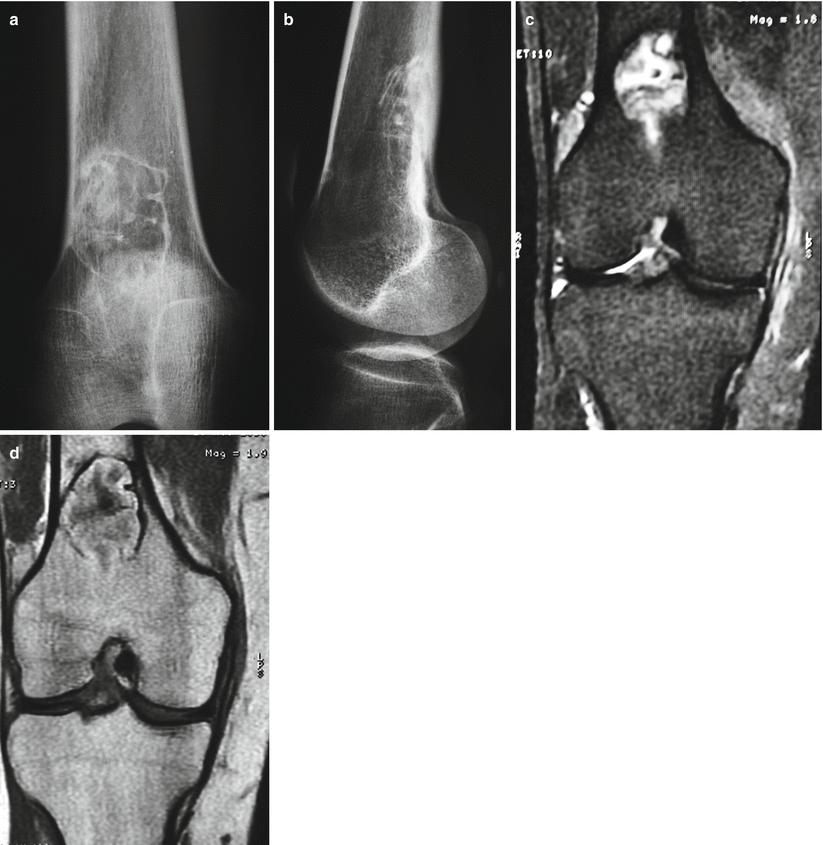 Bone Infarct | SpringerLink