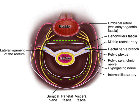 Total Mesorectal Excision with Autonomic Nerve Preservation: “Optimized ...