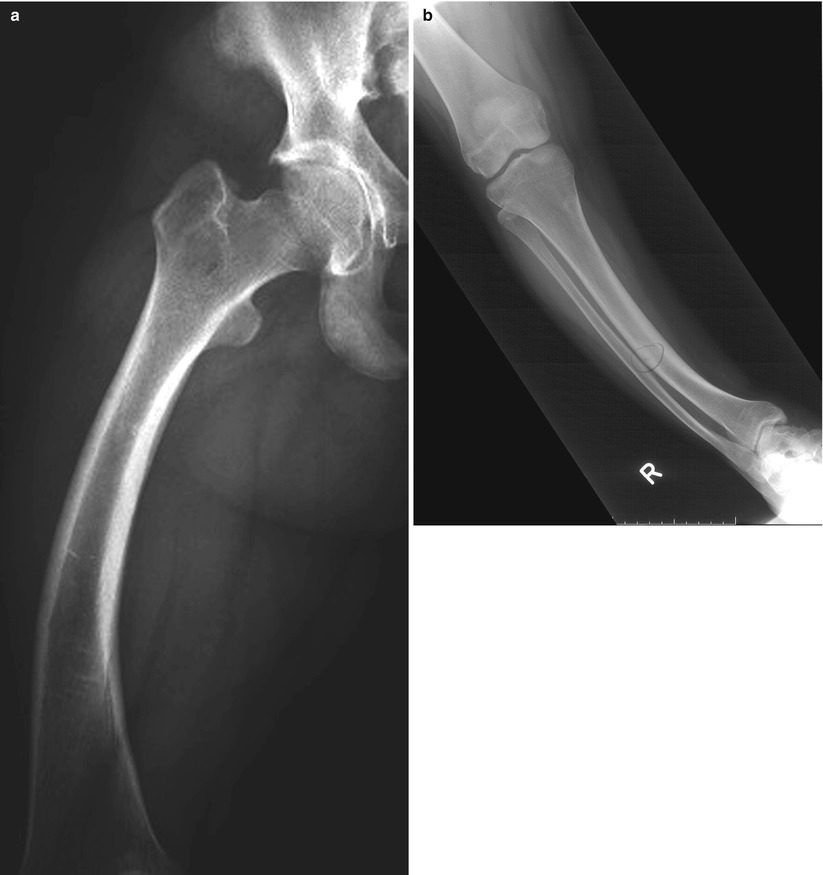 Congenital Bone Disorders | SpringerLink