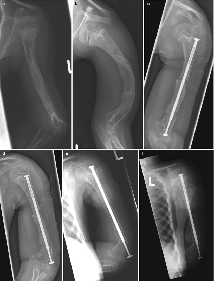 Congenital Bone Disorders | SpringerLink