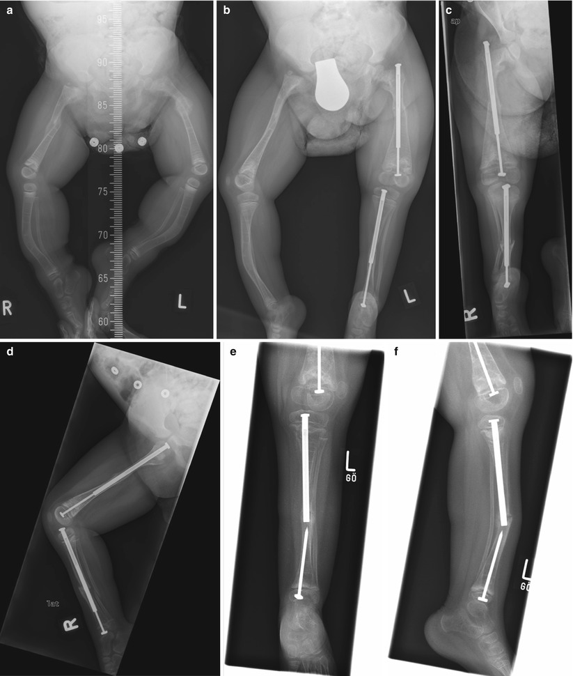 Congenital Bone Disorders | SpringerLink