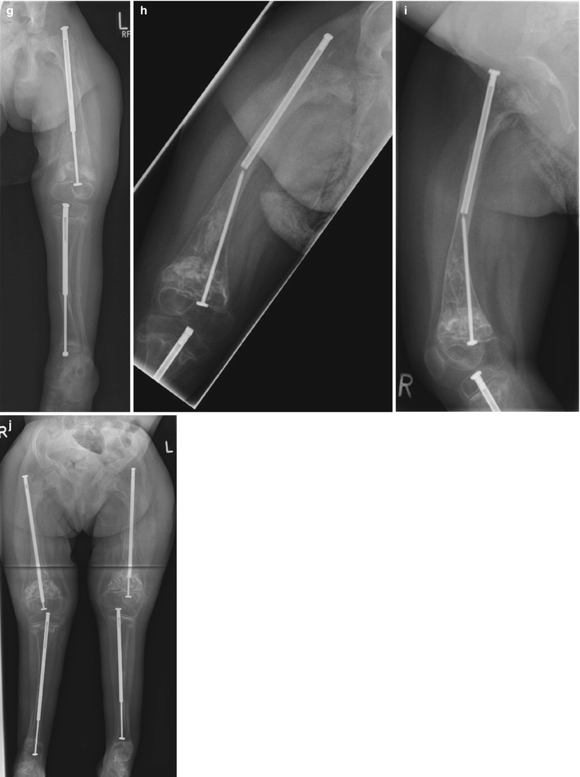 Congenital Bone Disorders | SpringerLink