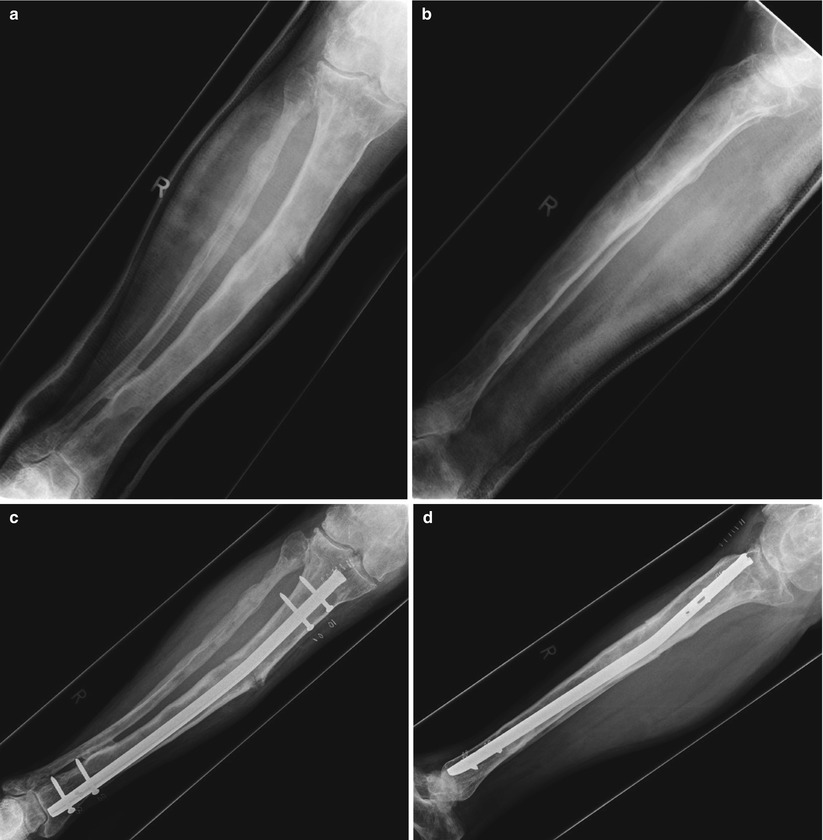 Congenital Bone Disorders | SpringerLink