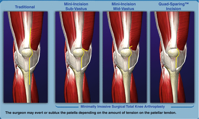Long Term Results of Total Knee Arthroplasty. The Effect of Surgical ...