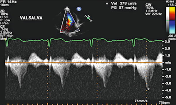 Hypertrophic Cardiomyopathy and Mitral Valve Disease | SpringerLink