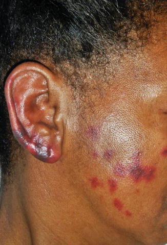 Drug-Induced Vasculitis | SpringerLink