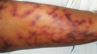 Drug-Induced Vasculitis | SpringerLink