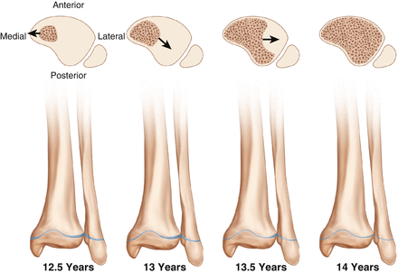Paediatric Tibial Fractures | SpringerLink