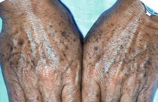 Lentigo and Solar Lentigines | SpringerLink