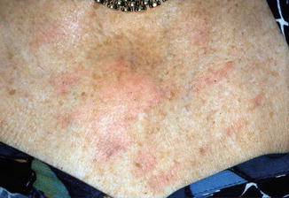 Lentigo and Solar Lentigines | SpringerLink