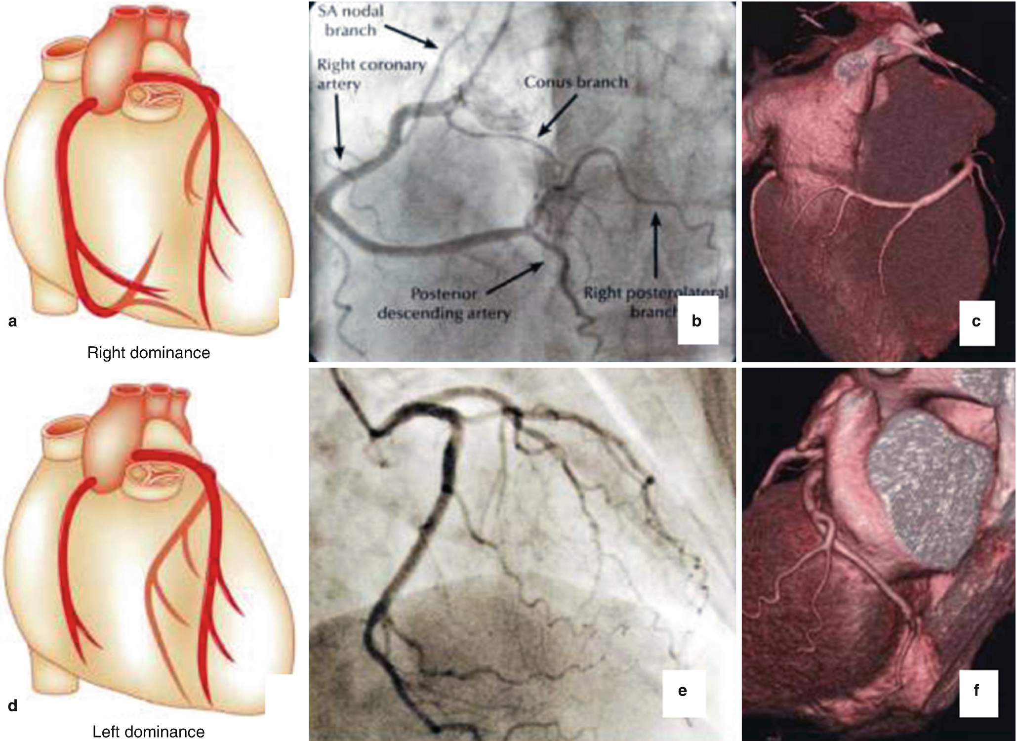 Normal Coronary Anatomy | SpringerLink