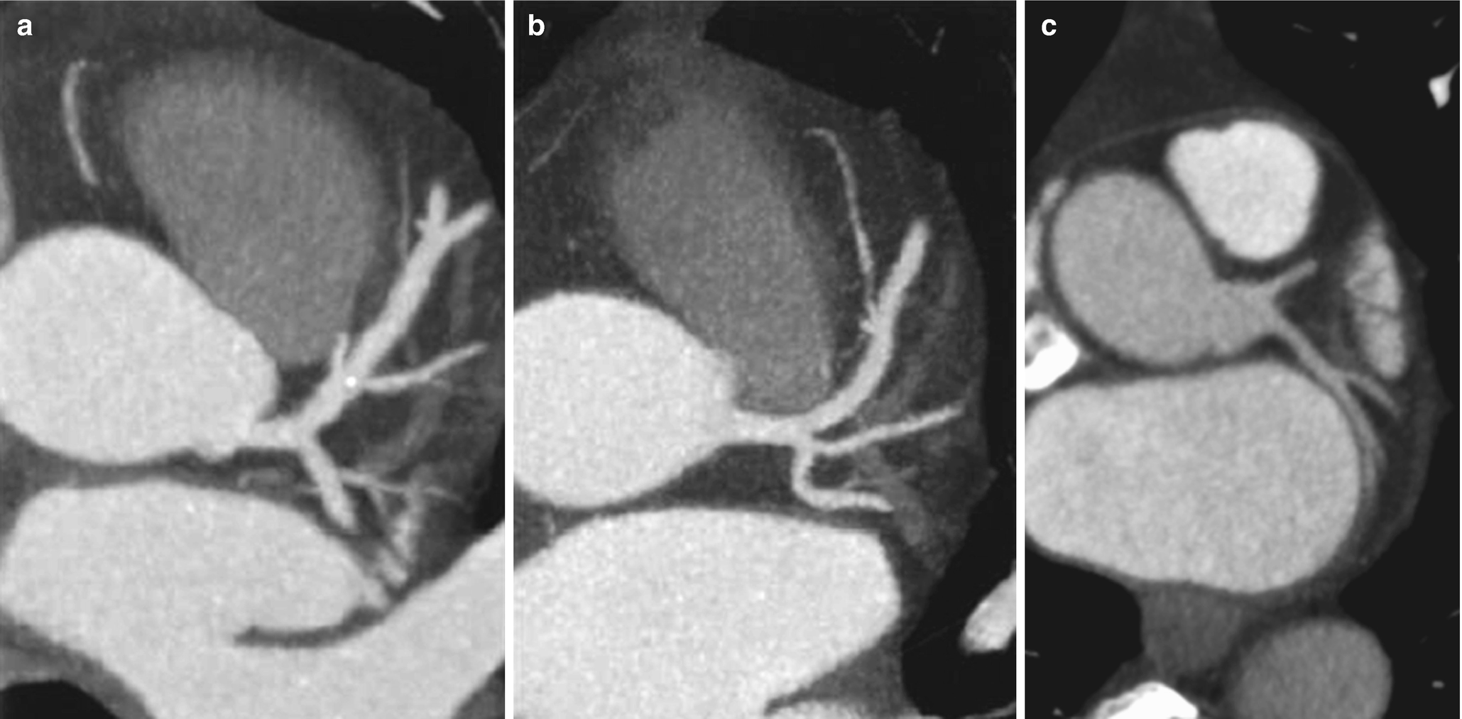 Normal Coronary Anatomy | SpringerLink