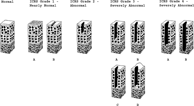 General Treatment Algorithm for Cartilage Defects | SpringerLink
