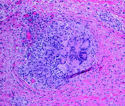 Cutaneous Manifestations of Gastrointestinal Diseases | SpringerLink