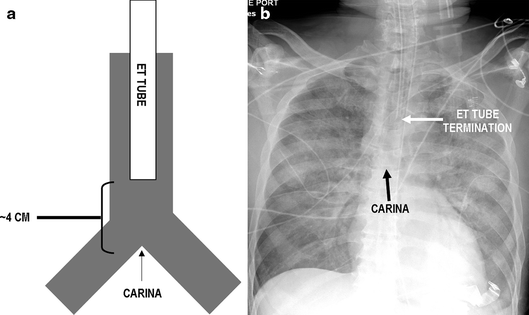 Tubes and Lines | SpringerLink