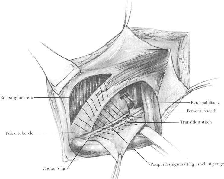 Cooper’s Ligament (McVay) Repair of Inguinal Hernia | SpringerLink