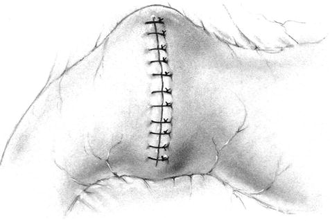 Pyloroplasty (Heineke-Mikulicz and Finney), Operation for Bleeding ...