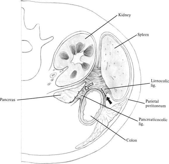 Left Colectomy for Cancer | SpringerLink