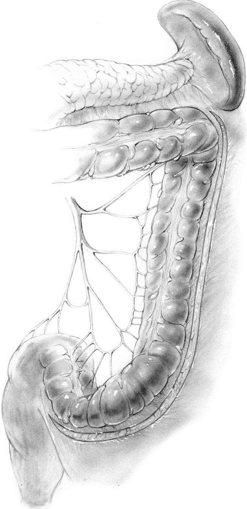 Subtotal Colectomy with Ileoproctostomy or Ileostomy | SpringerLink