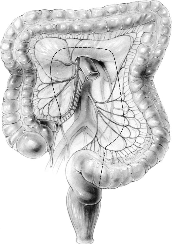 Subtotal Colectomy with Ileoproctostomy or Ileostomy | SpringerLink