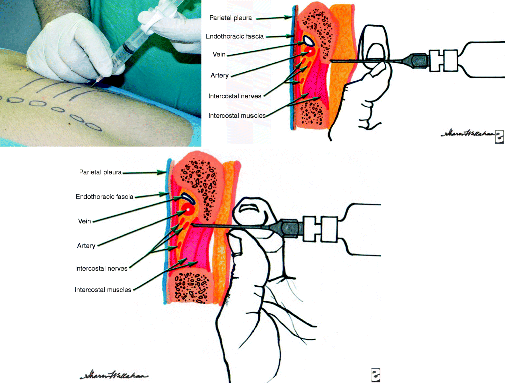 Intercostal Nerve Blocks Springerlink