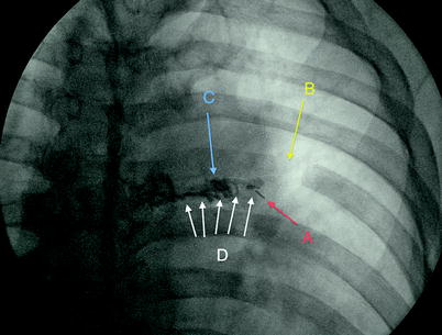 Intercostal Nerve Blocks | SpringerLink
