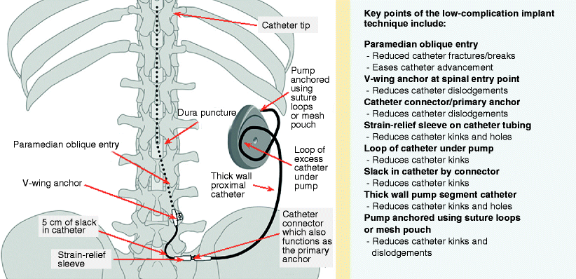 Intrathecal Drug Delivery for Control of Pain | SpringerLink