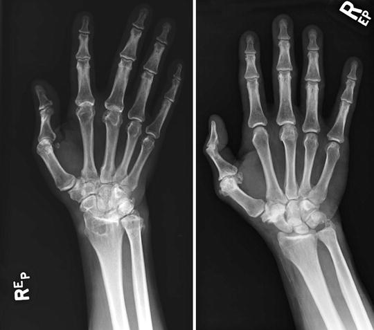 Wrist Arthritis: Arthroscopic Techniques of Synovectomy, Abrasion ...